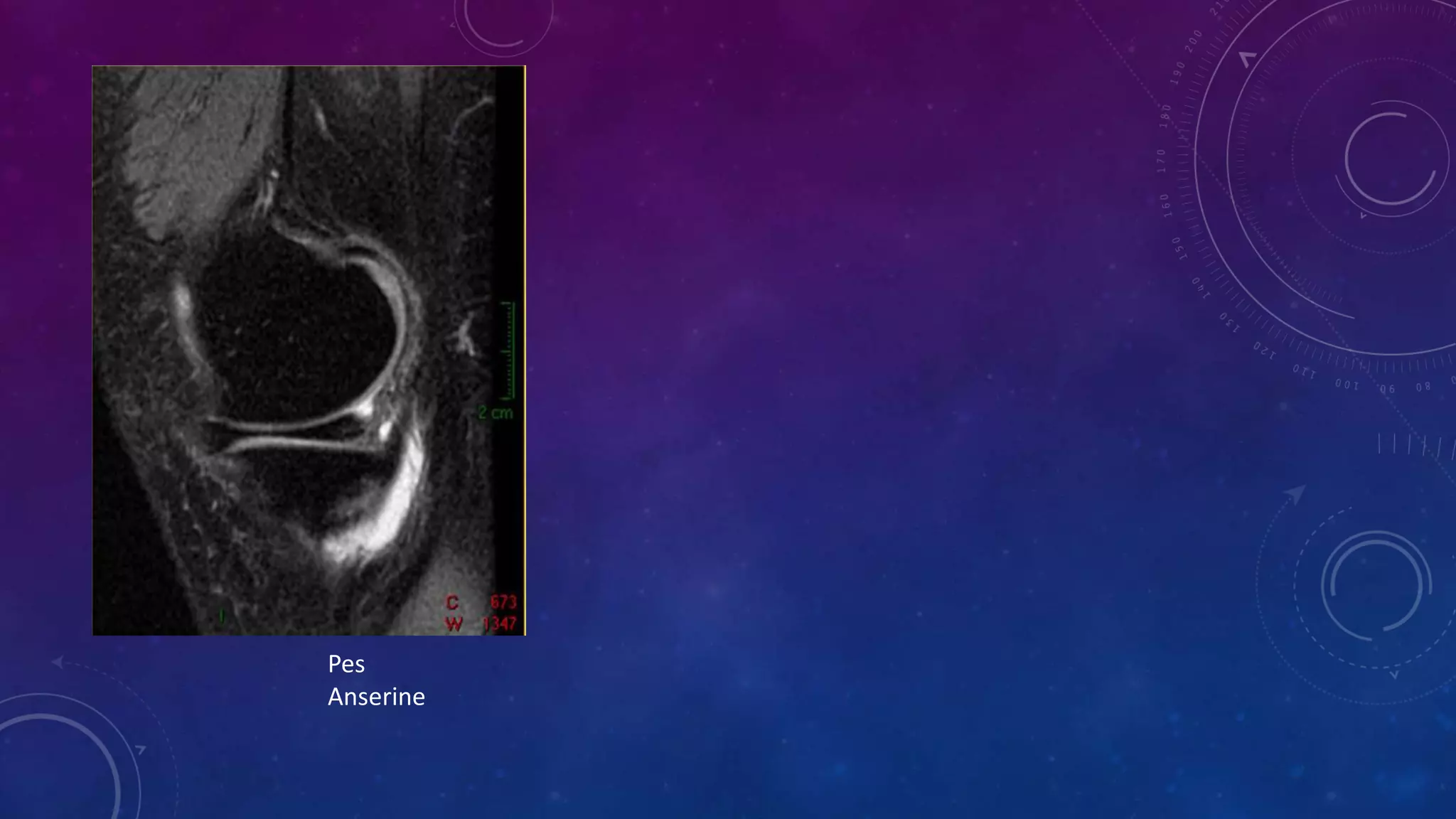 ACL anterior crucitae ligament anamtomy and physical therapy | PPTX