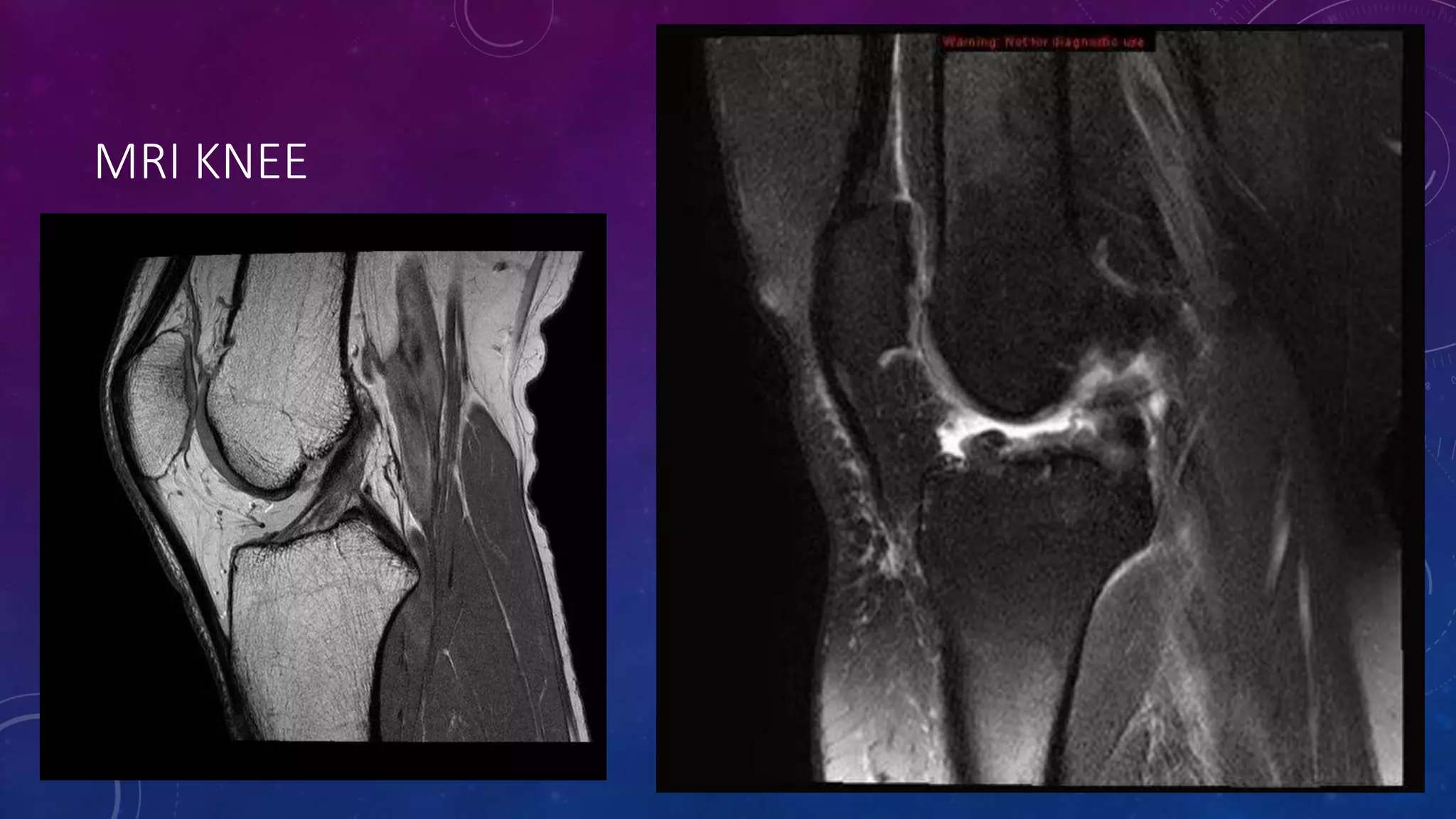 ACL anterior crucitae ligament anamtomy and physical therapy | PPTX
