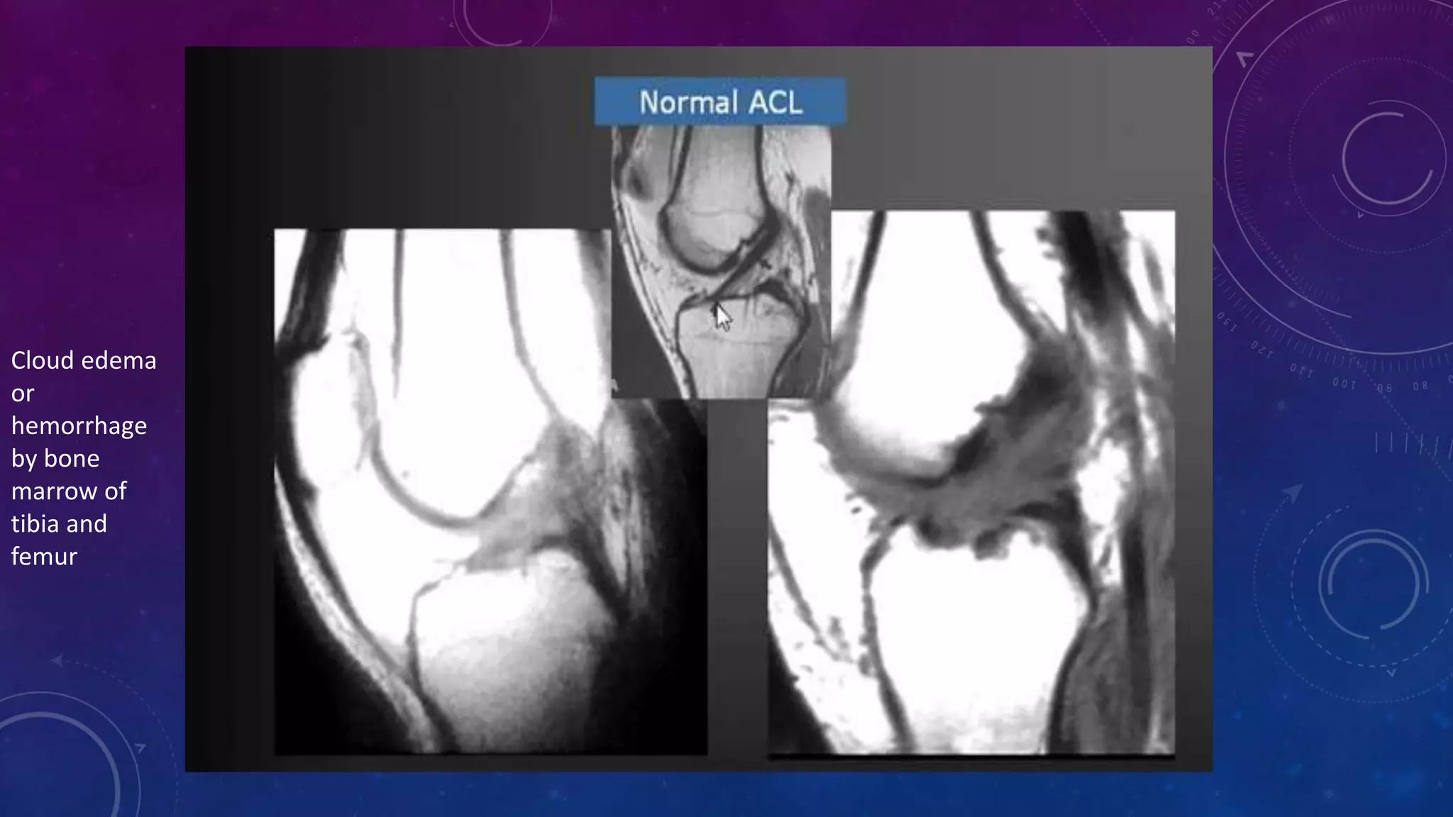 ACL anterior crucitae ligament anamtomy and physical therapy | PPTX
