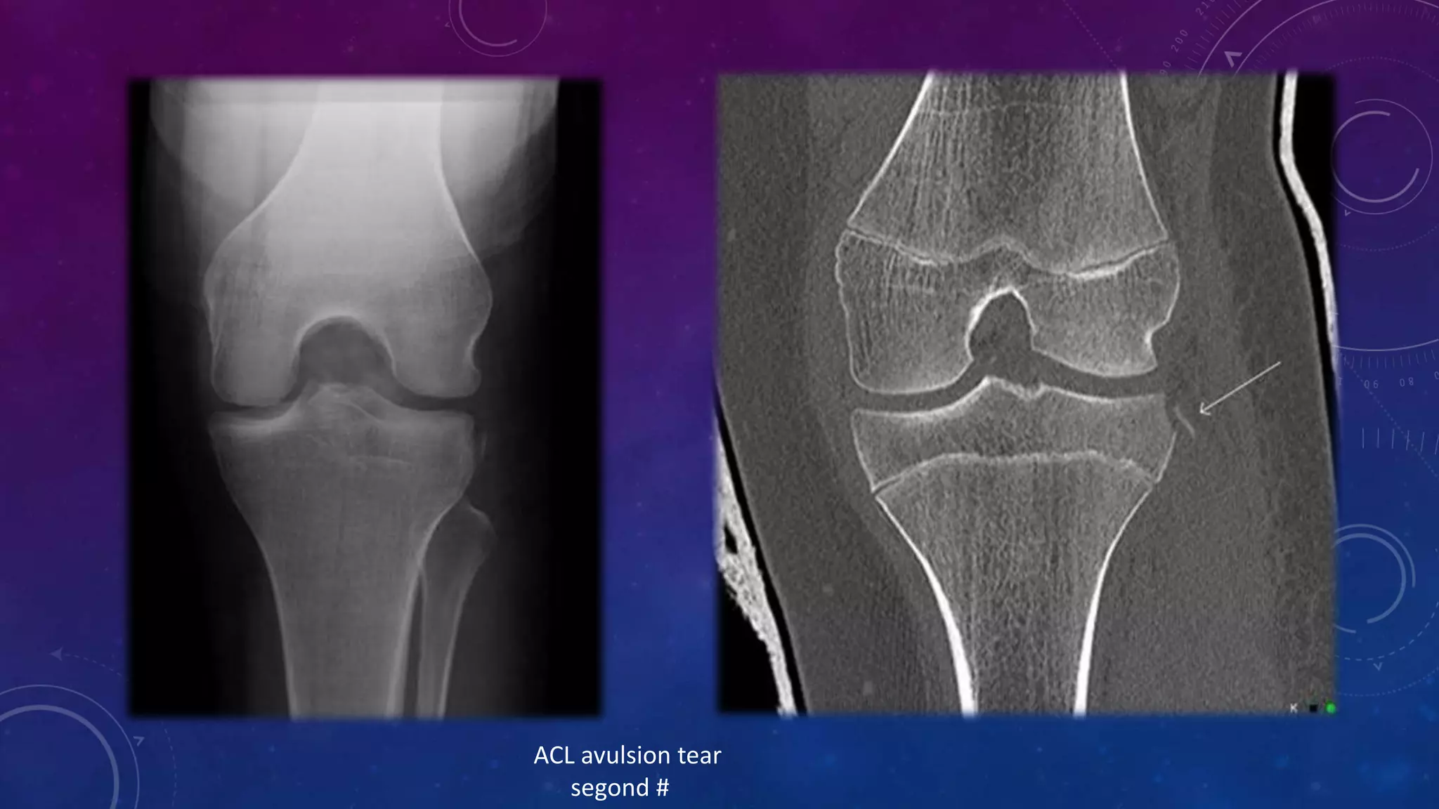 ACL anterior crucitae ligament anamtomy and physical therapy | PPTX