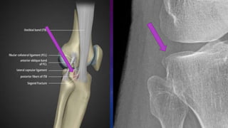 ACL anterior crucitae ligament anamtomy and physical therapy | PPTX