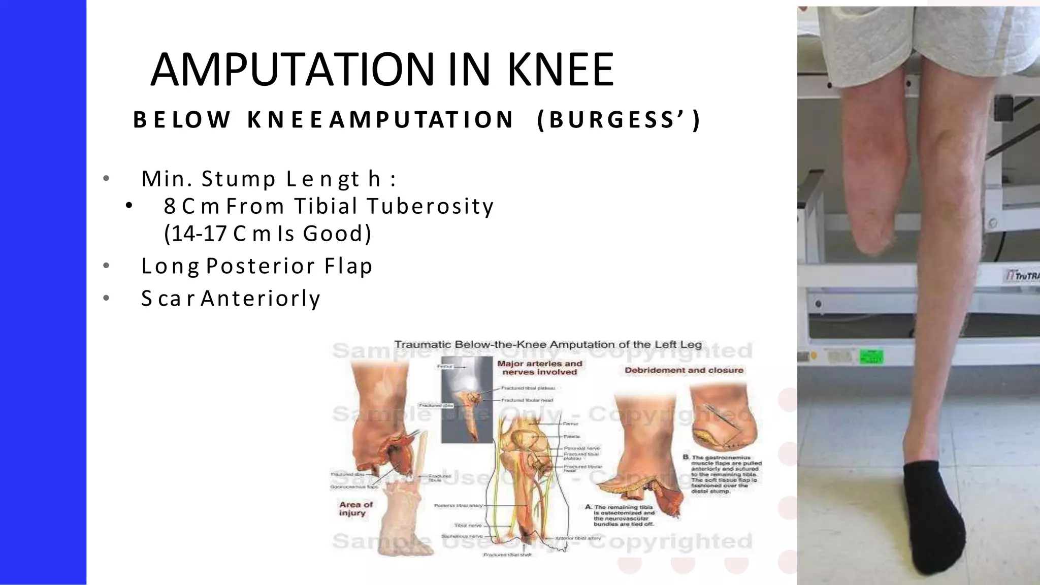 Knee Amputation.pptx