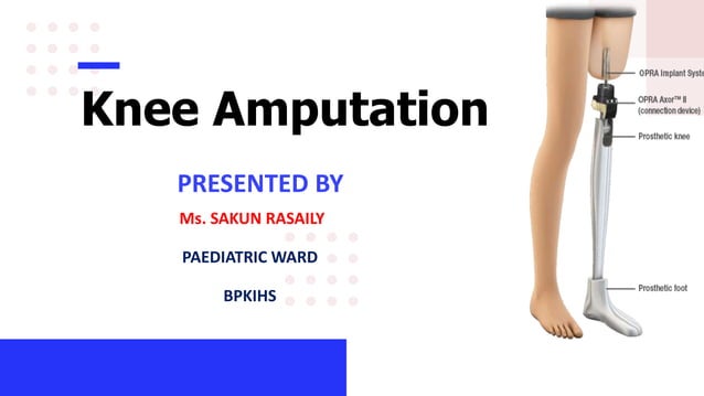 Knee Amputation.pptx