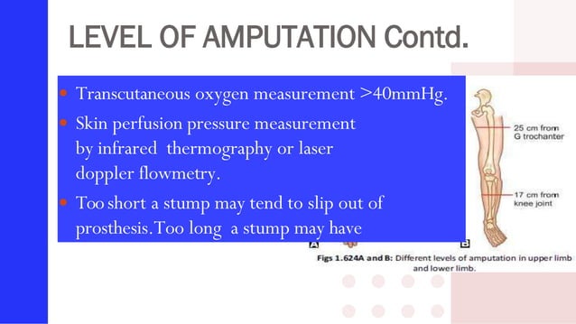 Knee Amputation.pptx