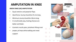 Knee Amputation.pptx