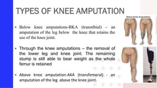Knee Amputation.pptx