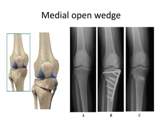 Knee anatomy,surgical approches & osteoarthritis of the knee | PPT