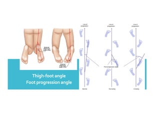Knee and Foot Deformities in pediatrics.pdf | Death, Injury, or ...