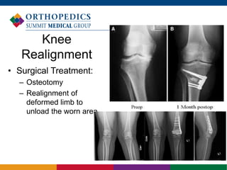 Understanding Knee Arthritis and Cartilage Disorders - Maurice M. Pine ...
