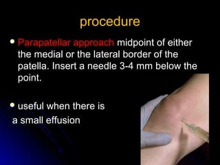 Knee arthrocentesis | PPT