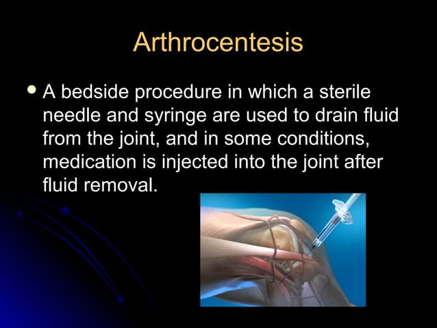 Knee arthrocentesis | PPT