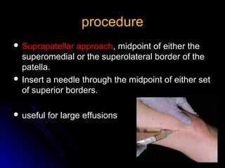 Knee Arthrocentesis Landmarks