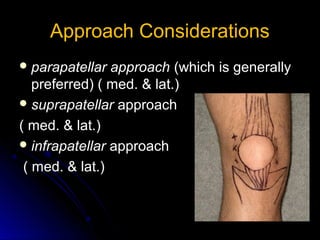 Knee Arthrocentesis Landmarks
