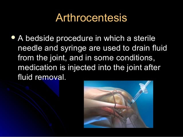 Knee arthrocentesis