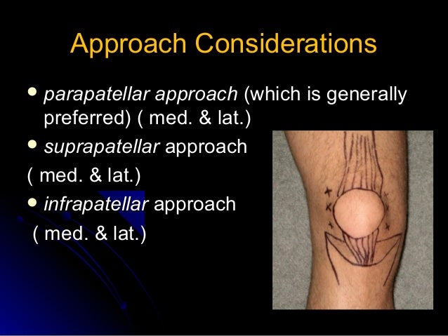 Knee arthrocentesis