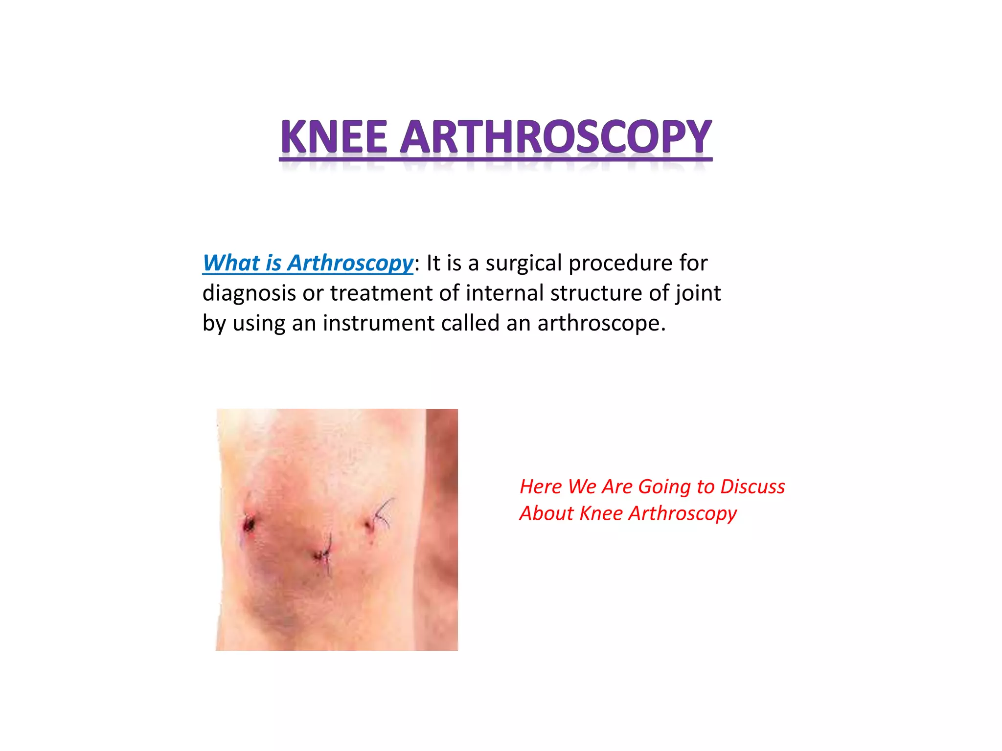 Knee Arthroscopic Surgery | PPTX