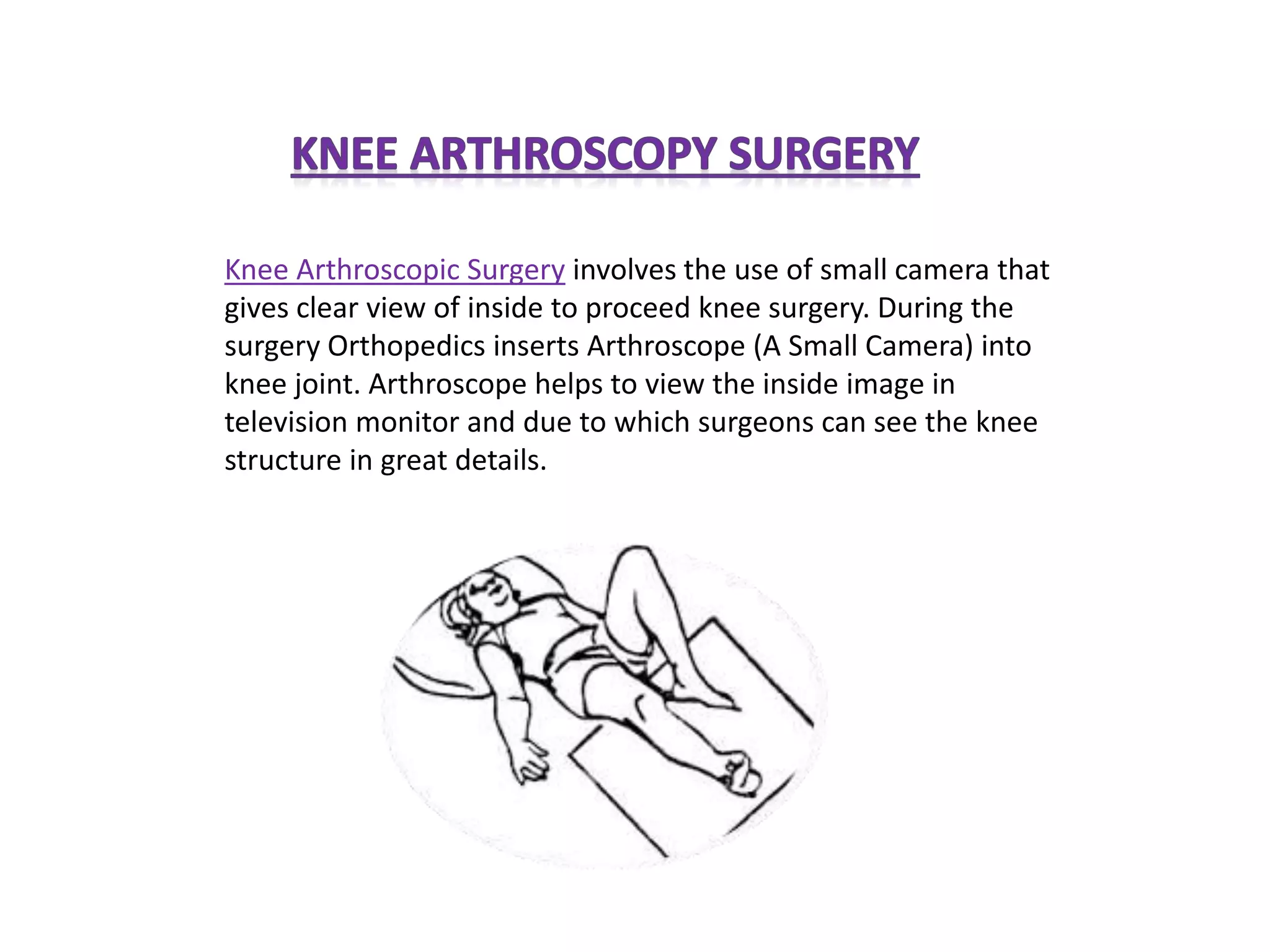 Knee Arthroscopic Surgery | PPTX