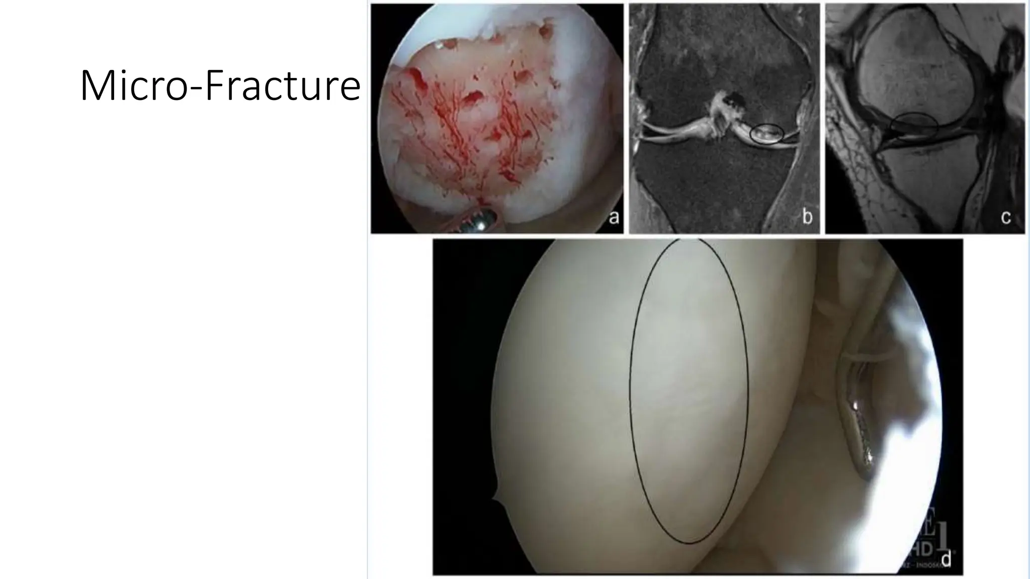 Articular Cartilage Injuries of the Knee.pptx