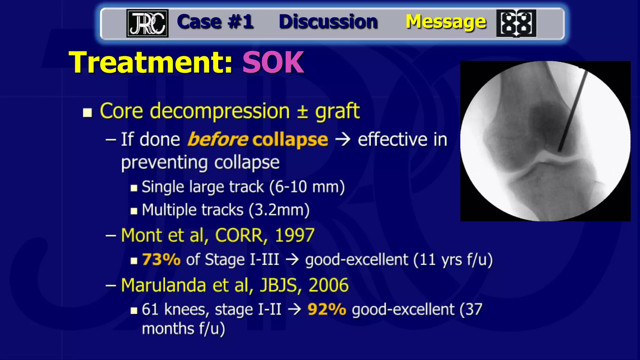 Knee Osteonecrosis | PPT
