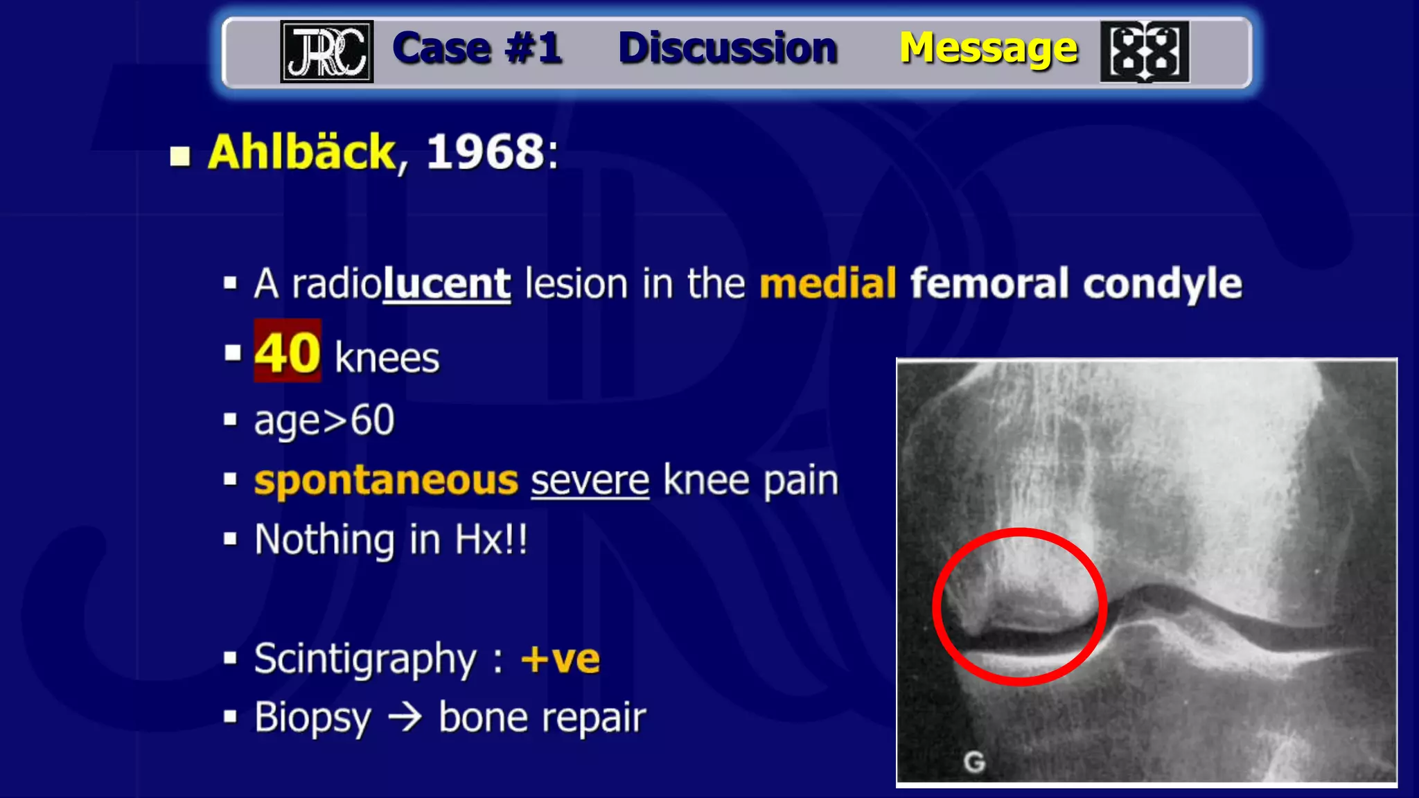 Knee Osteonecrosis | PPT