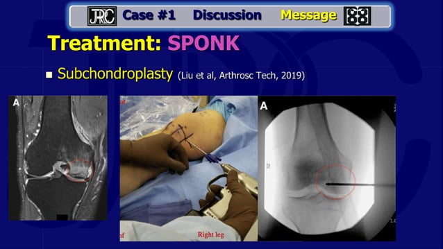 Knee Osteonecrosis | PPT