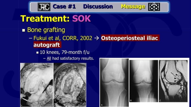 Knee Osteonecrosis | PPT
