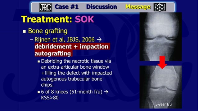 Knee Osteonecrosis | PPT