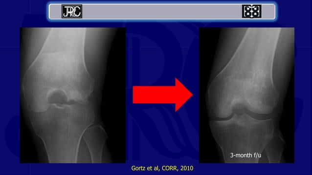 Knee Osteonecrosis | PPT