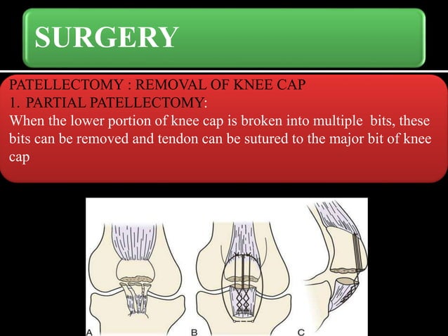 Knee cap (Patella) fractures | PPTX
