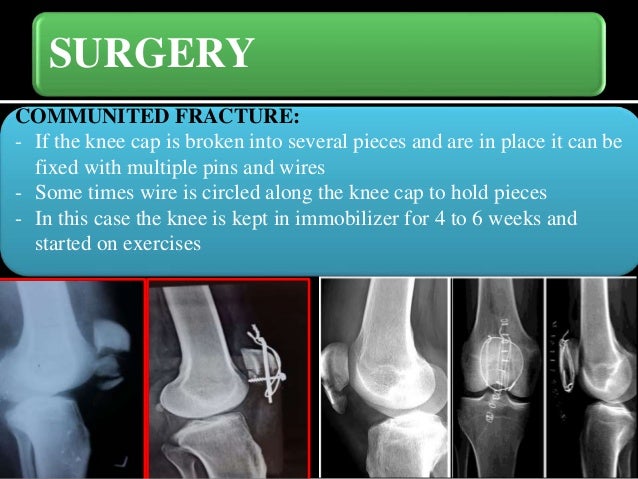 Knee cap (Patella) fractures