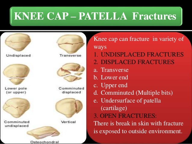 Knee cap (Patella) fractures