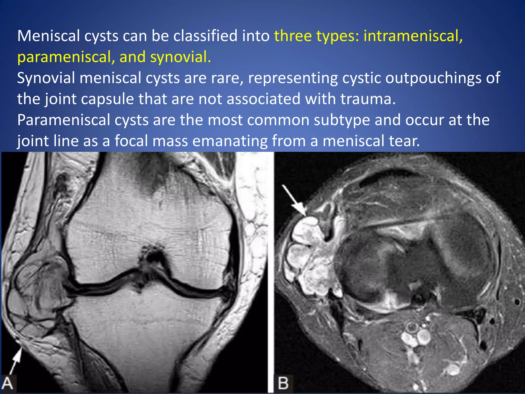 Knee cystic lesions | PPT