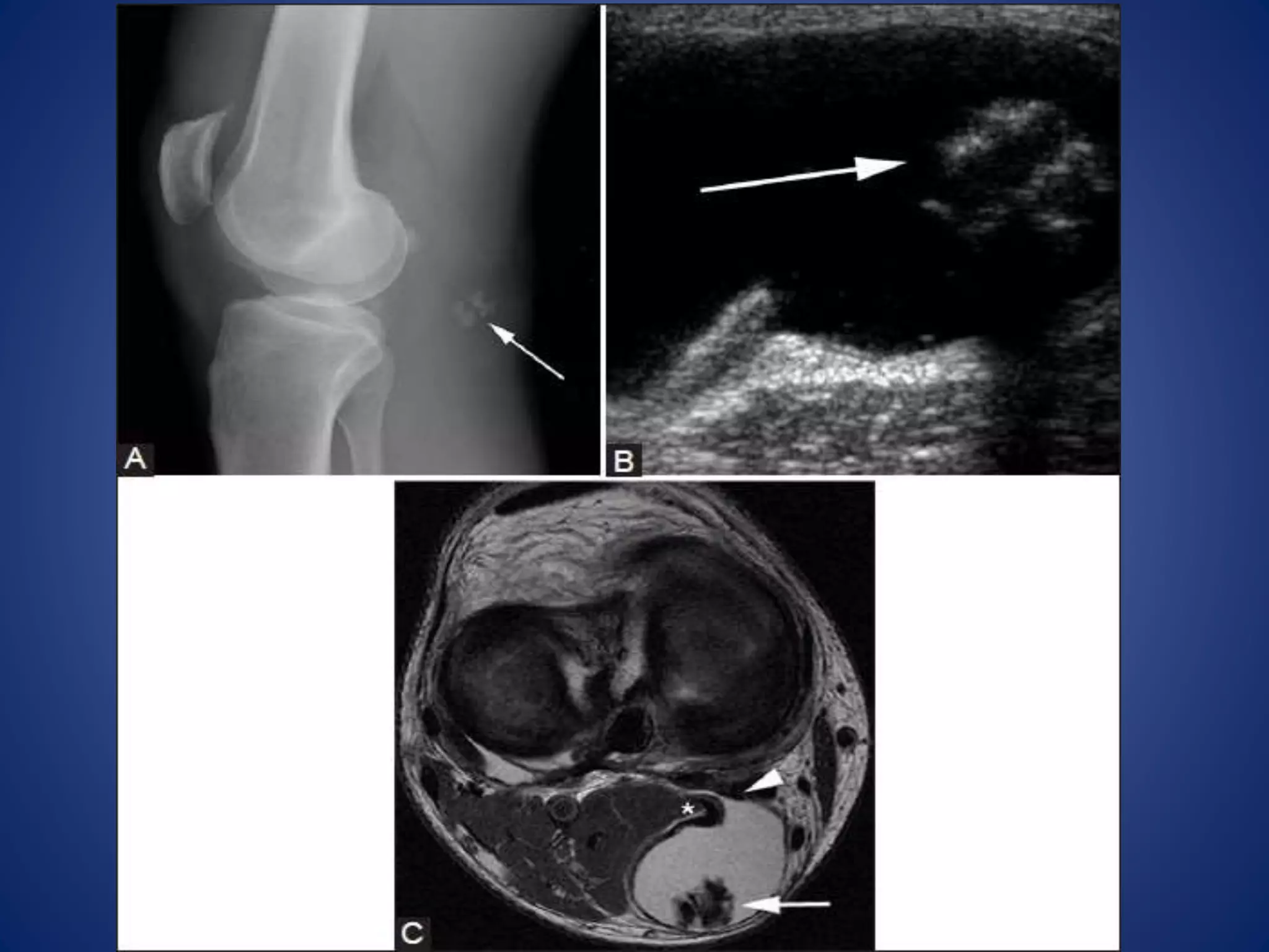 Knee cystic lesions | PPTX