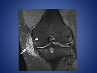 Knee cystic lesions | PPTX