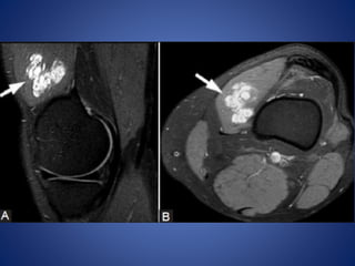 Pcl Ganglion Cyst Mri