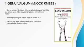 KNEE DEFORMITIES AROUND THE KNEE JOINT.pptx