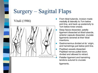 Knee_Disarticulation.pdf fully described and explained | PDF