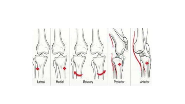 knee dislocation.pptx