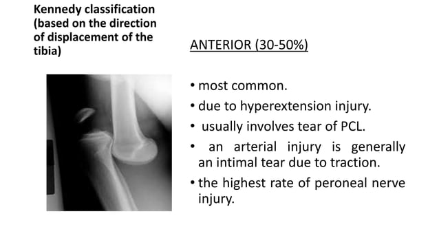 knee dislocation.pptx