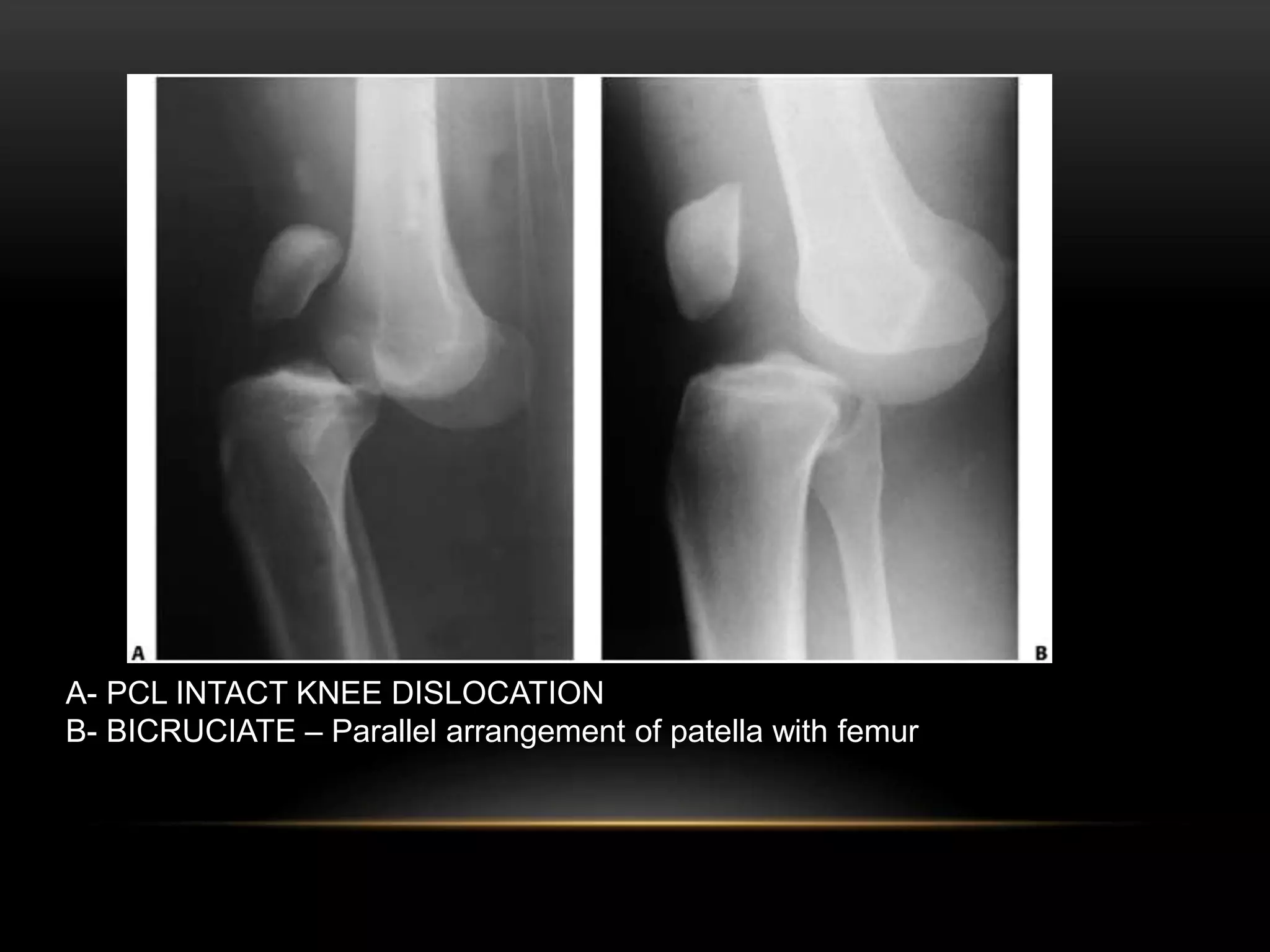 Knee dislocation | PPTX