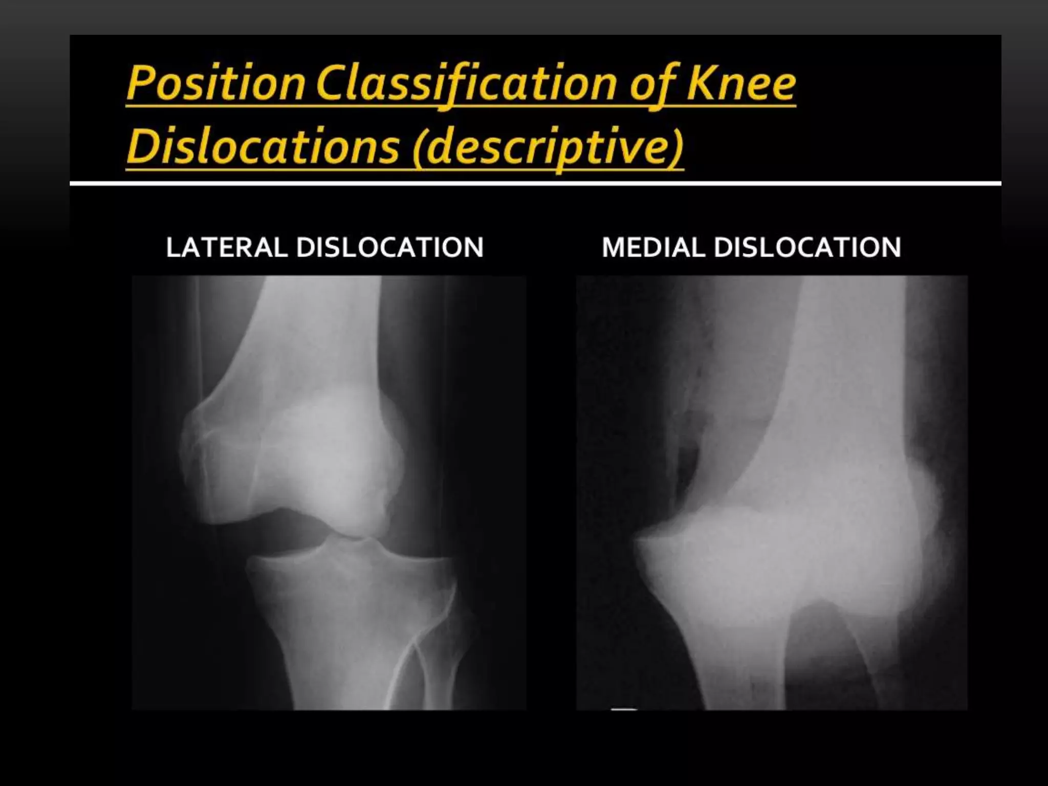 Knee dislocation | PPTX