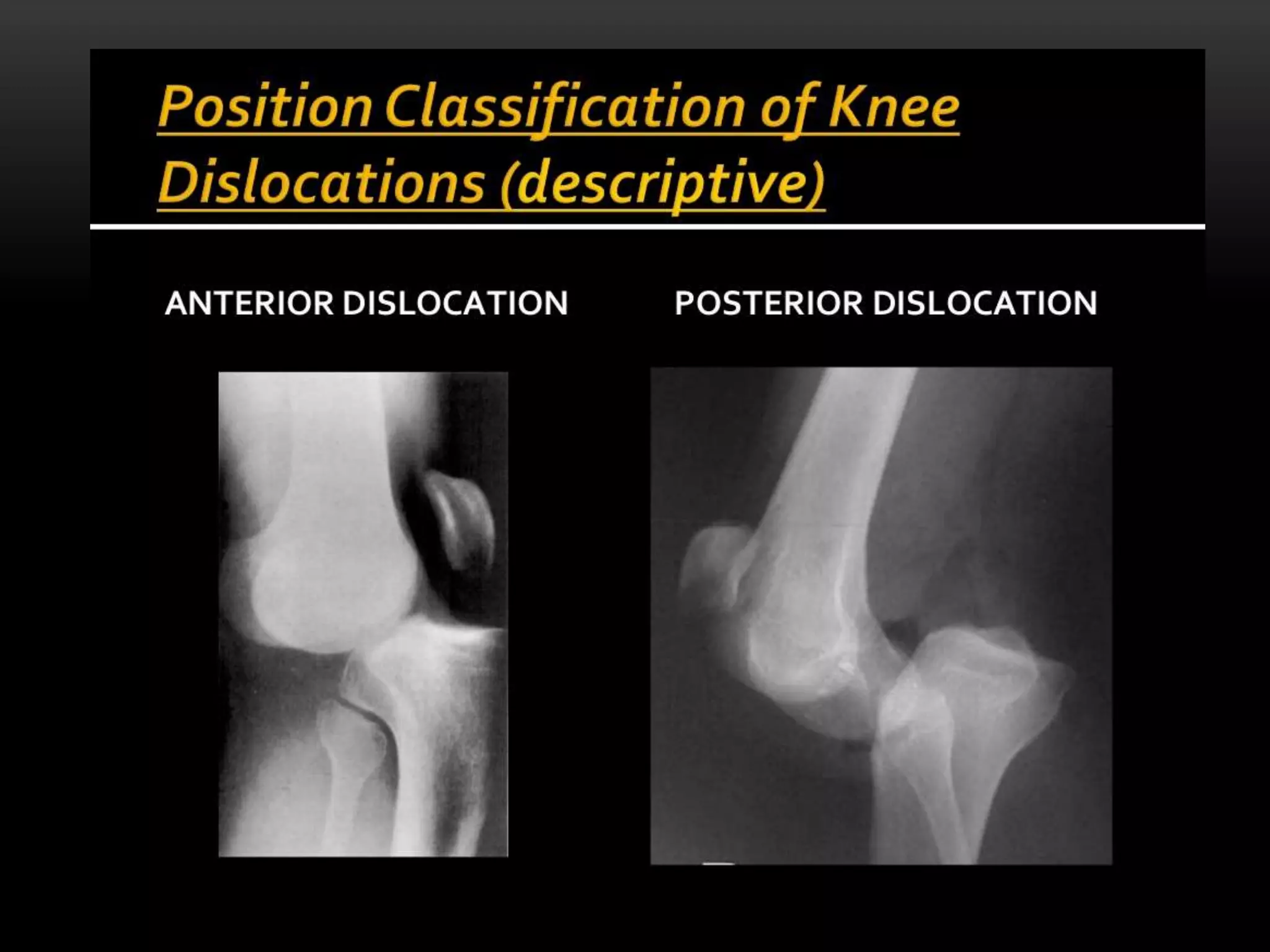 Knee dislocation | PPTX