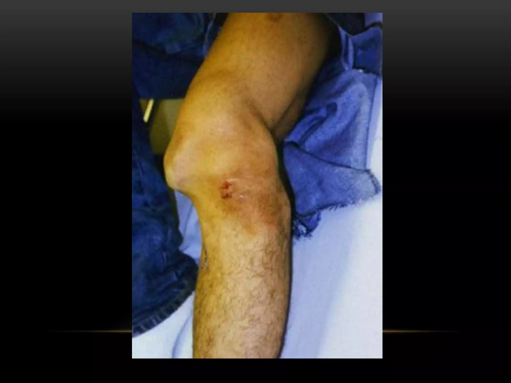 Knee dislocation | PPTX