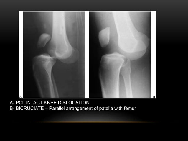 Knee dislocation | PPTX