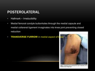 Knee dislocation | PPTX