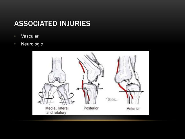 Knee dislocation | PPTX