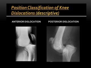 Knee dislocation | PPT