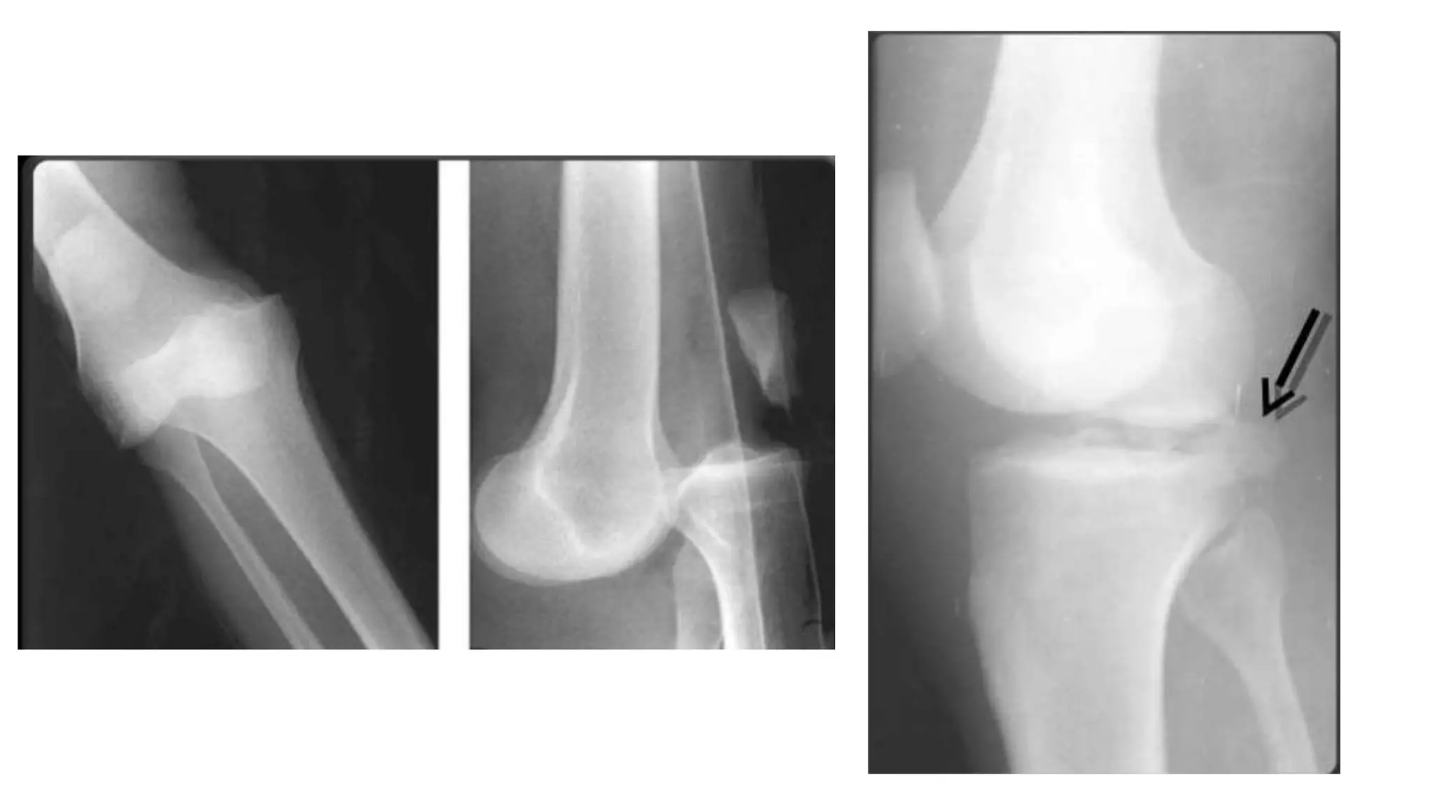 Knee dislocation | PPTX