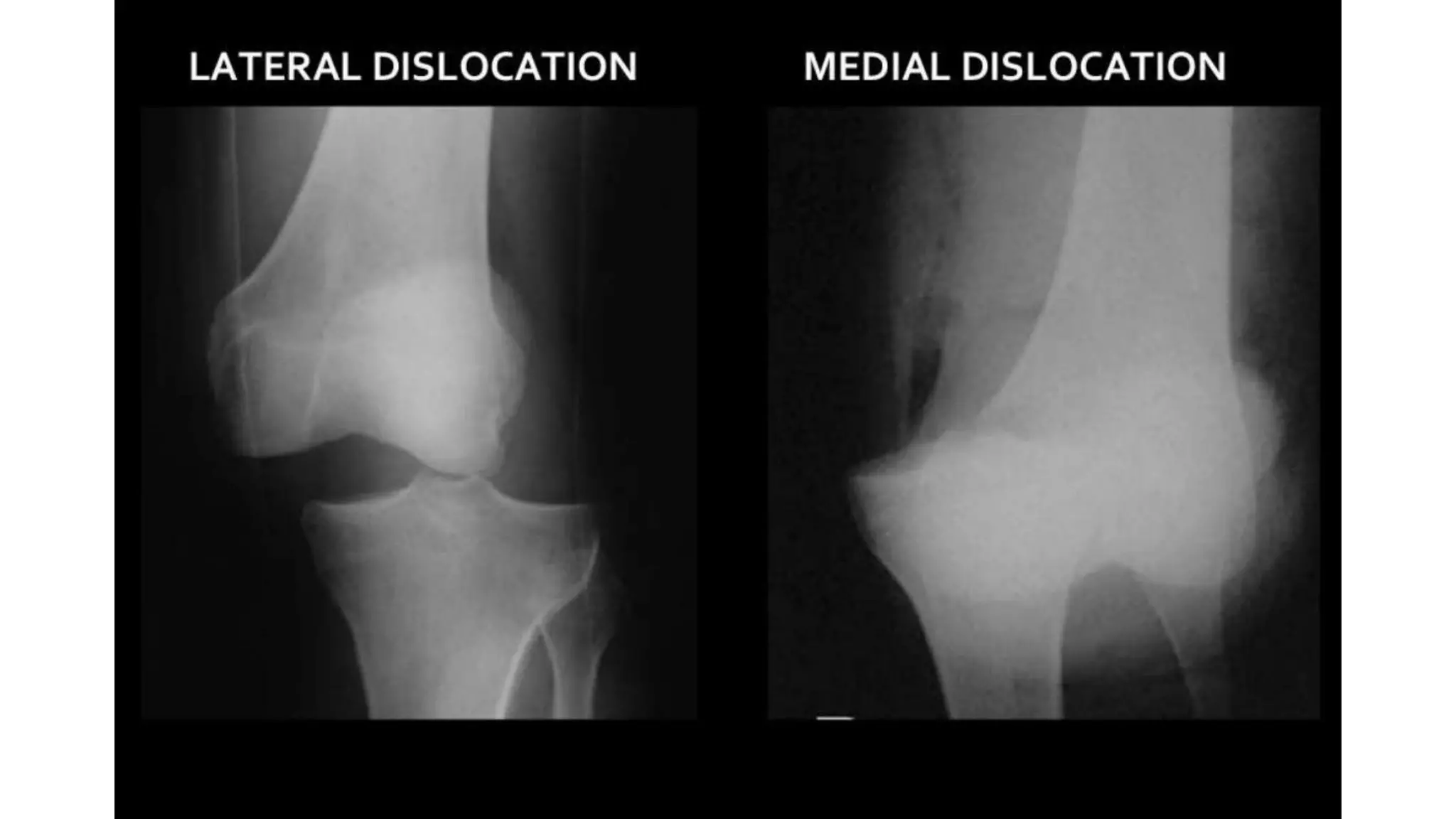 Knee dislocation | PPTX