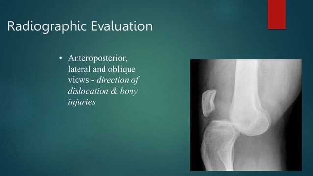 Knee dislocation.pptx | Death, Injury, or Military Conflict | Sensitive ...